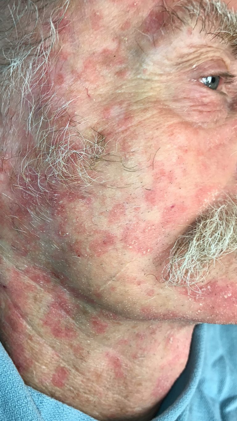 Skin Cancer - Dr. Kate Kelly - The Ottawa Clinic