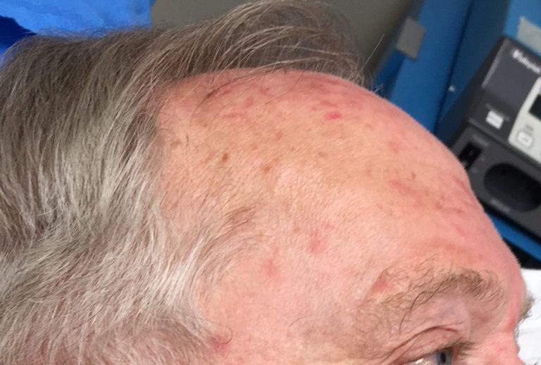 Skin Cancer - Dr. Kate Kelly - The Ottawa Clinic